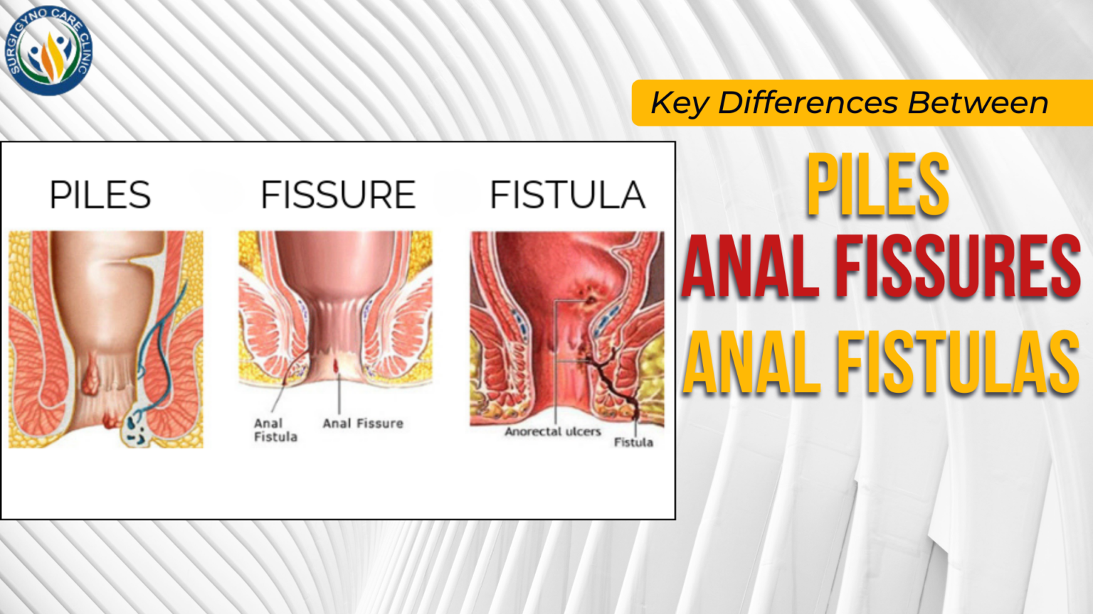 Key Difference Between Piles, Anal Fissure, and Anal Fistula